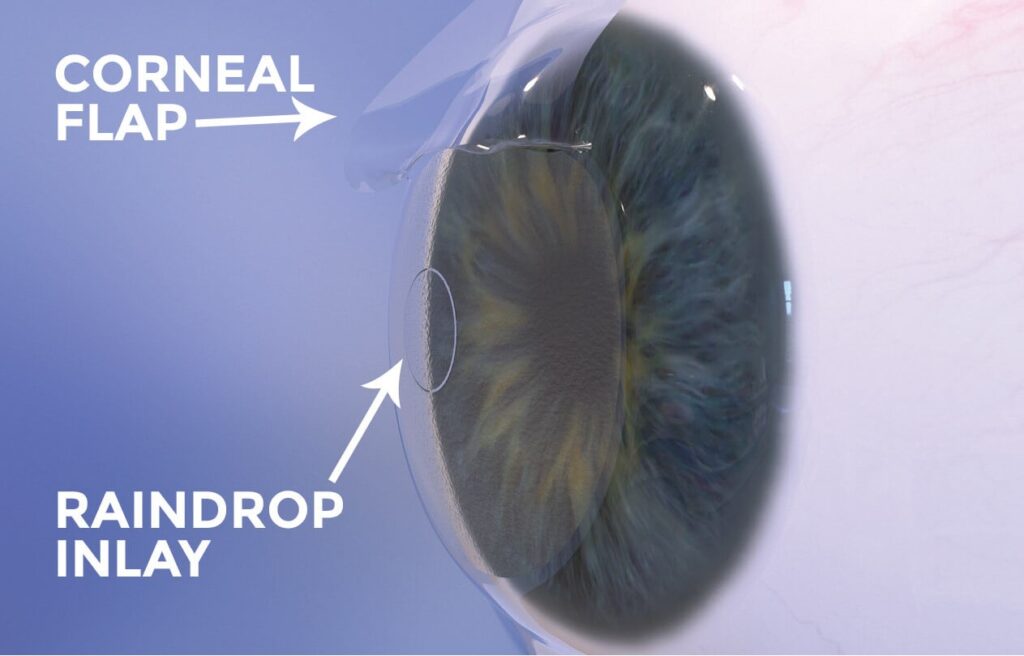 Near-Vision Corrective Surgery | Michigan Eye Institute