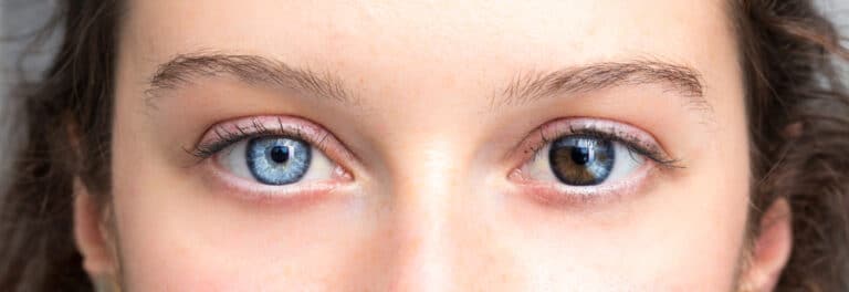 Heterochromatic Eyes: What Is Heterochromia? | MEI